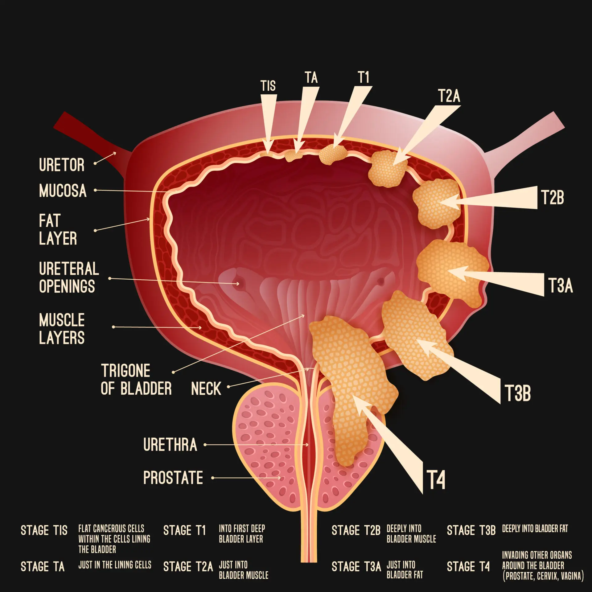 Bladder Cancer Staging